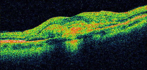 Wet Amd Oct DRI OCT 1 Atlantis > GALLERY | Topcon Medical Systems,